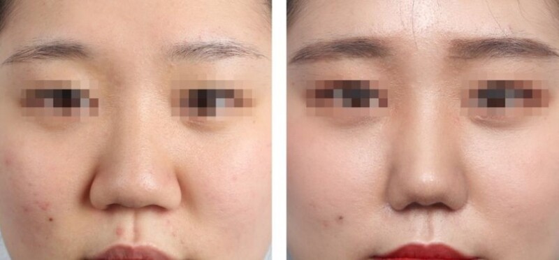 Cánh mũi to khi cười – Nguyên nhân và cách làm cánh nhỏ mũi lại ...